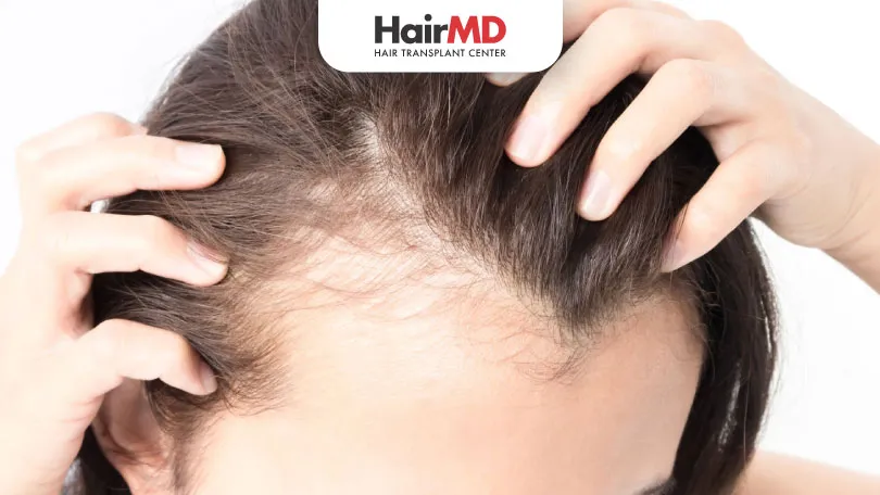 Treating Female Pattern Baldness: Key Signs and Causes